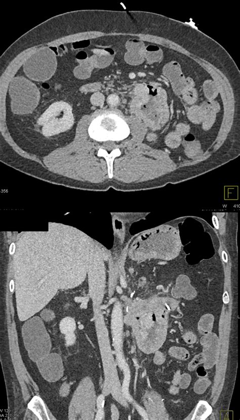 Gastrointestinal Learning Modules Ct Scanning