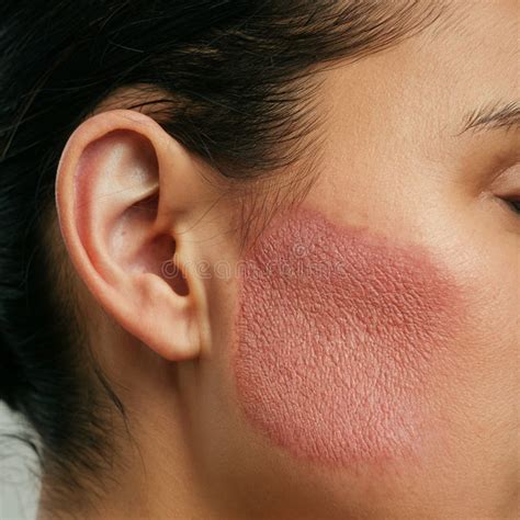 Close Up Of Scaly Pinkish Skin Patch Near Ear Contrasting Smoother