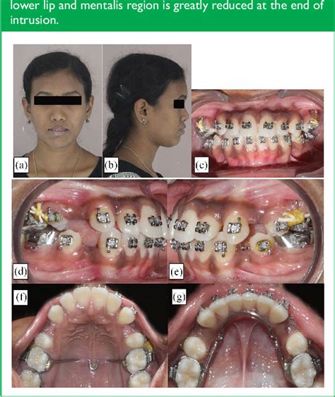 Figure 3 From Intrusion Of The Maxillary Posterior Teeth With A Single Buccal Mini Implant