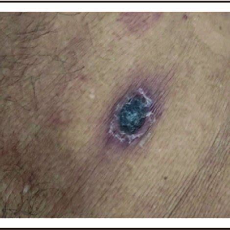 Eschar A Diagnostic Clue To Scrub Typhus Source Original Download