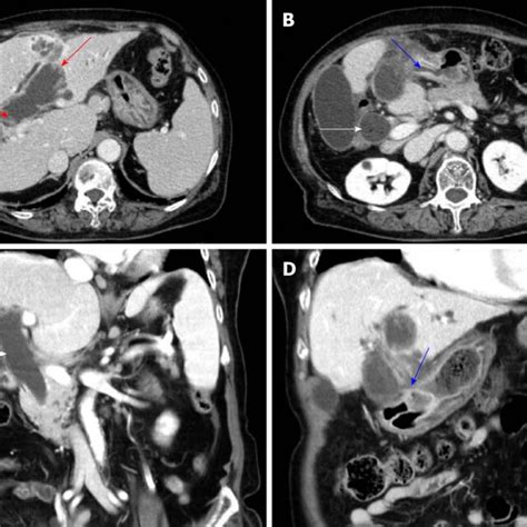 Computed Tomography Of The Abdomen Showed Markedly Dilated Common Bile