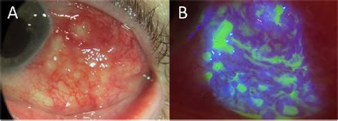 Slit Lamp Photograph At Presentation Demonstrates Left Eye