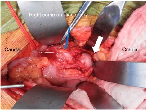 Macroscopic Image Of The Metastatic Para Aortic Lymph Node Download Scientific Diagram