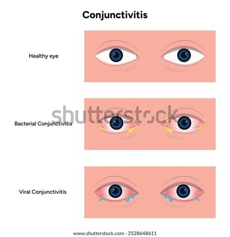 84 Bacteria Contact Lenses Stock Vectors And Vector Art Shutterstock
