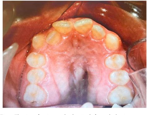 Figure 1 From Persistent Palatal Hypertrophy Associated With Rapid