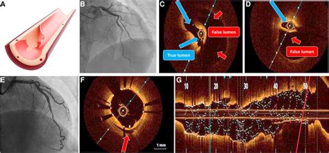 Scad Type 1 A Illustration Of Intimal Tear B Angiographic