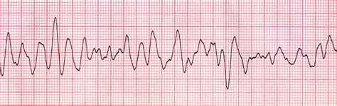 Topic Using The Algorithm For Cardiac Arrest For Shockable Rhythms