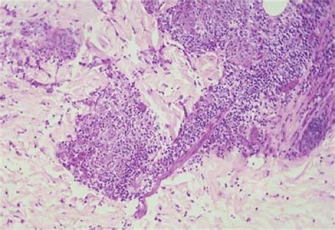 Lymphogranuloma Venereum Lymphadenitis Basicmedical Key