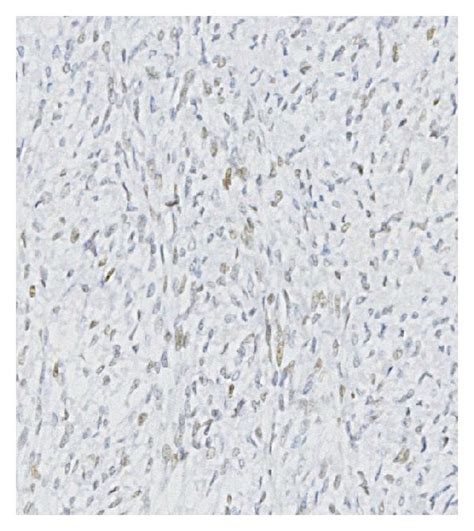 Macroscopic And Microscopic Findings Of The Tumor In The Peritoneal