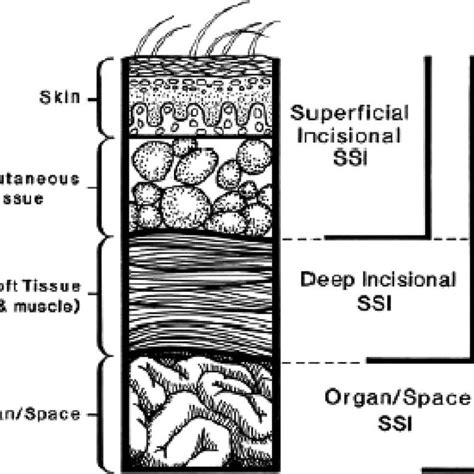 Schematic Representation Depicting Classification Of Surgical Site