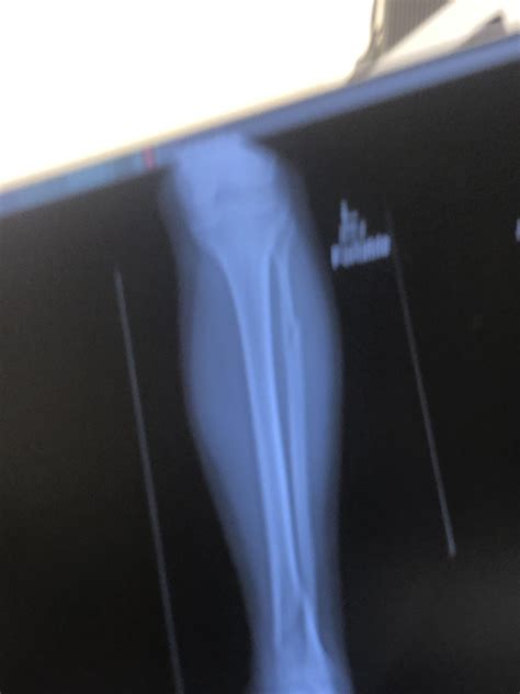 Broke My Tibia And Fibula Falling Off A Roof At Work So Long Strong Boners R Neverbrokeabone