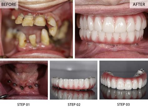 Full Dental Implants Before And After Dental Implants Nashua Nh