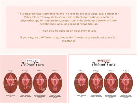 Perineal Tears Png Images And Canva Templates Pdf  Episiotomy