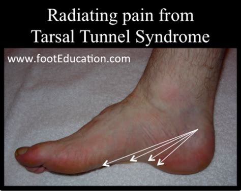 Tarsal Tunnel Syndrome Footeducation