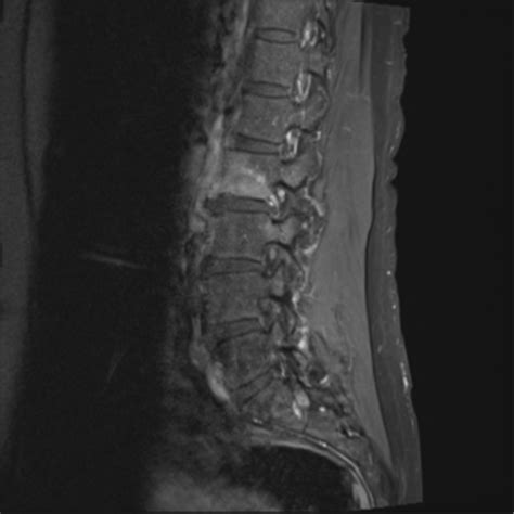 Radiopaedia Case Discitis Osteomyelitis Eikenella Corrodens Id 46558
