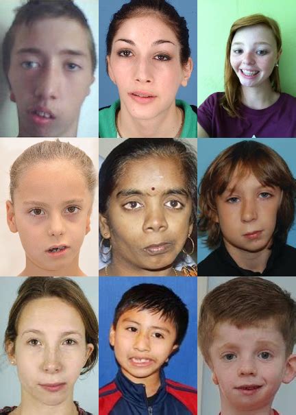 The Visual Representaion Of Hemifacial Microsomia Hfm Dataset Download Scientific Diagram