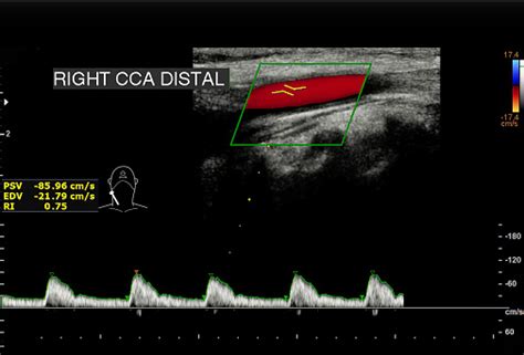A Carotid Artery Doppler Ultrasound Is A Diagnostic Test Used To Check