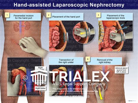 Hand Assisted Laparoscopic Nephrectomy