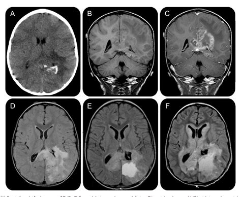 Figure 1 From Necrotizing Granulomatous Meningoencephalitis Due To Balamuthia In An