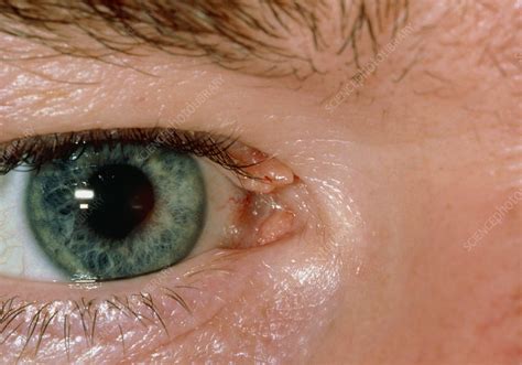 Wart On Upper Eyelid Stock Image M1550147 Science Photo Library