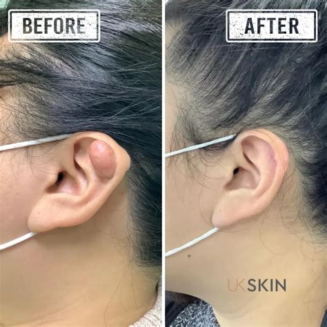 Small Earlobe Keloid