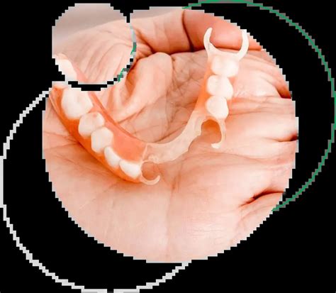 Flexible Dentures In Chennai Flexible Dentures Treatment In Chennai