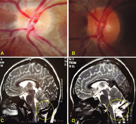 A Fundus Photo On Presentation Elevated Left Optic Disc With