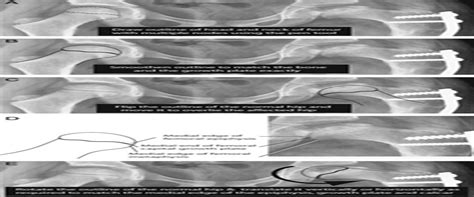 Does The Deformity Index Reliably Predict The Shape Of The F