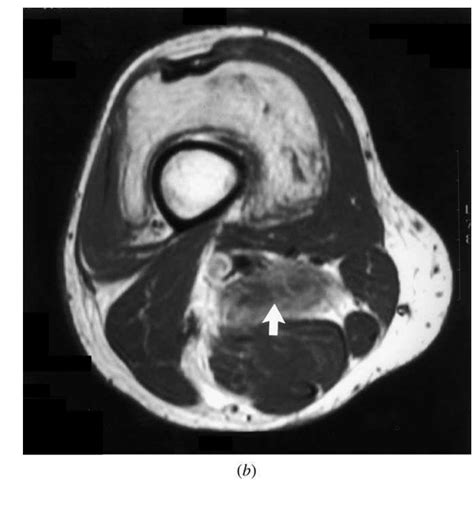 Figure 22 The Imaging Spectrum Of Bakers Popliteal