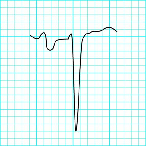 P7 Biphasic P Wave V1 Lae Acilci Net