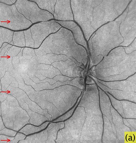 Saccade Detection Based On Svp Analysis A And D Svp Image Of The