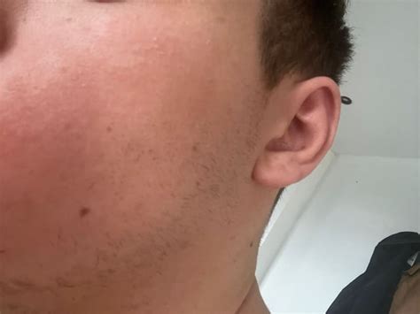 Small Pimples Everywhere Rmedicaladvice