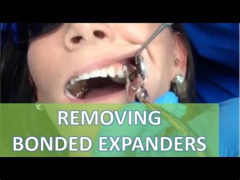 Removing A Bonded Expander Rpe Orthodontic Matters Episode 3 Youtube