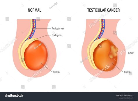 Testicular Cancer Diagram Testicular Cancer Abdominal Key