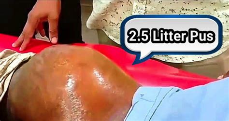 Large Buttock Abscess Pus Drainage New Pimple Popping Videos