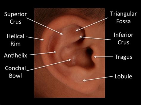 Stahl Ear Deformity — Dr Derderian — Plastic And Reconstructive Surgery