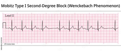 Poster Wenckebach Phenomenon Ecg Mobitz Type 1 Second Degree