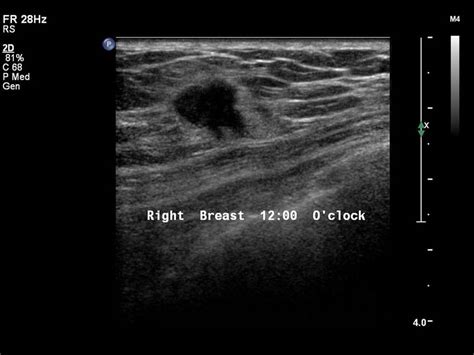 Atlas Of Breast Cancer Early Detection