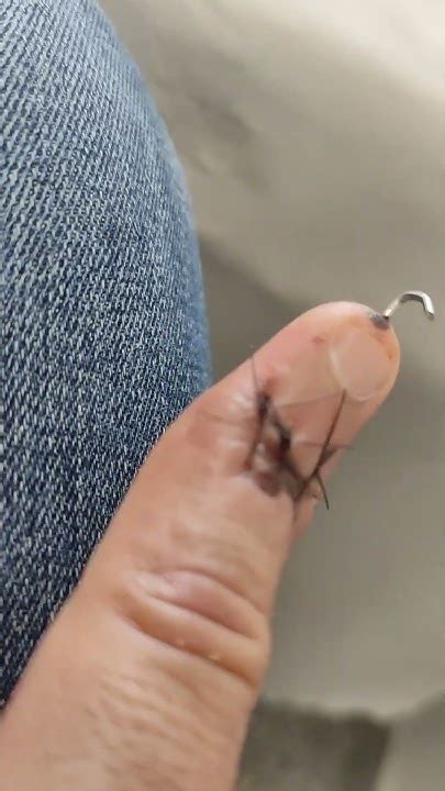 Cirurgia De Inserção Do Fio De Kirschner Youtube