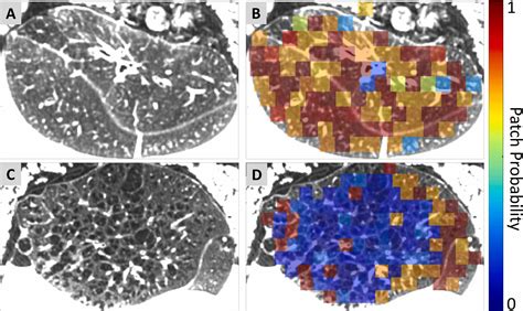 Computed Tomographybased Machine Learning For Donor Lung Screening
