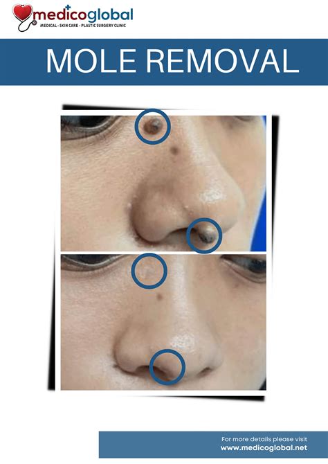 Medico Need A Mole Removal It Will Only Take About 10 15 Minutes