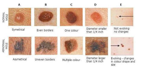 What Is The Abcde Rule Of Skin Cancer Outer Banks Dermatology Board
