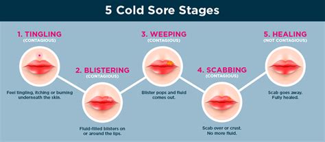Cold Sores Are Contagious Until Fully Healed Shine365 From Marshfield