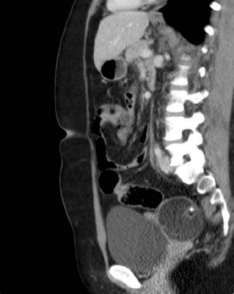 Abdomino Pelvic Ct Scan Showing No Metastatic Location Source Download Scientific Diagram