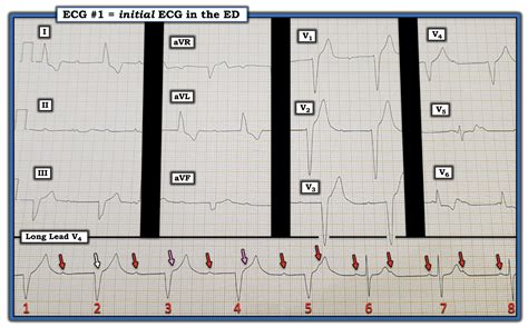 Ecg Interpretation Ecg Blog 235 51 — Is There Complete Av Block