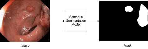 Github Sunlightwingskvasir Seg Segmentation Segmentation On Kvasir