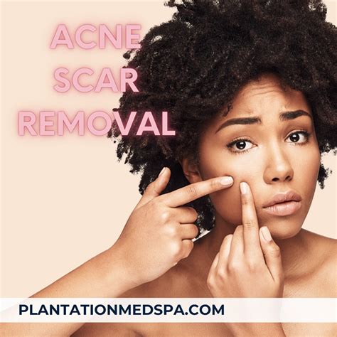 Reduce Acne Scar Treatment With Plex Plus