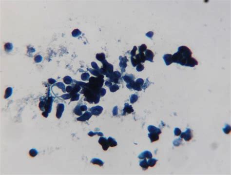 Small Nodular Swelling In The Right Side Of The Upper Lip Download