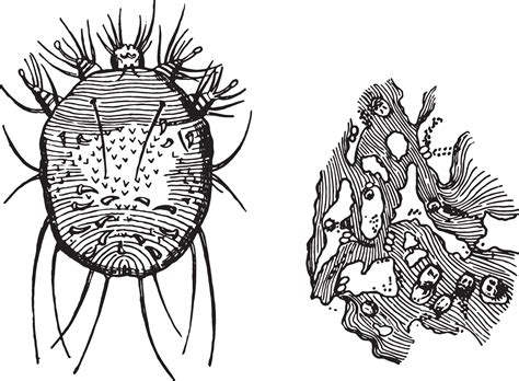 A Acarus Scabiei B Portion Of Epidermis Showing The Burrows With Their Contained Eggs Vintage