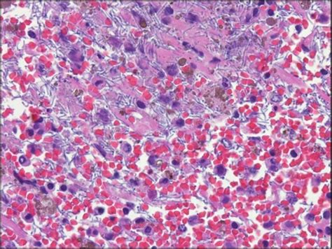 Anthrax Tetanus Botulism Clostridium Flashcards Quizlet
